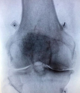 Genicular Nerve Blocks Vancouver - Dr. Craig Best - Dr. Craig Best