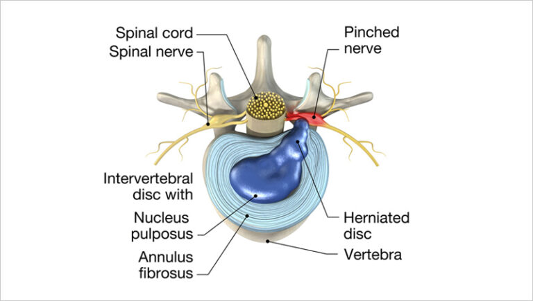 Cervical Disc Herniation Vancouver - Dr. Craig Best - Dr. Craig Best