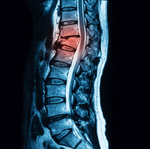 Vertebral Compression Fracture Vancouver - Dr. Craig Best - Dr. Craig Best